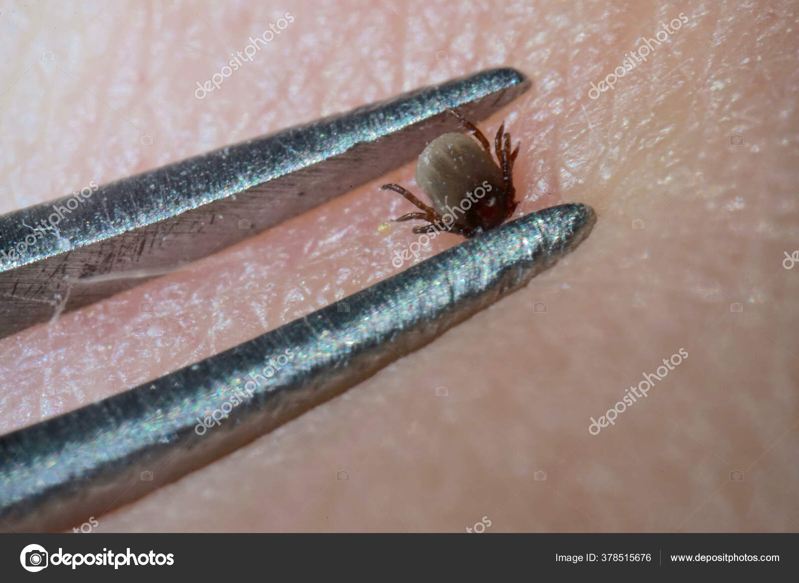 Tick Removal Human Neck at Eva Facy blog