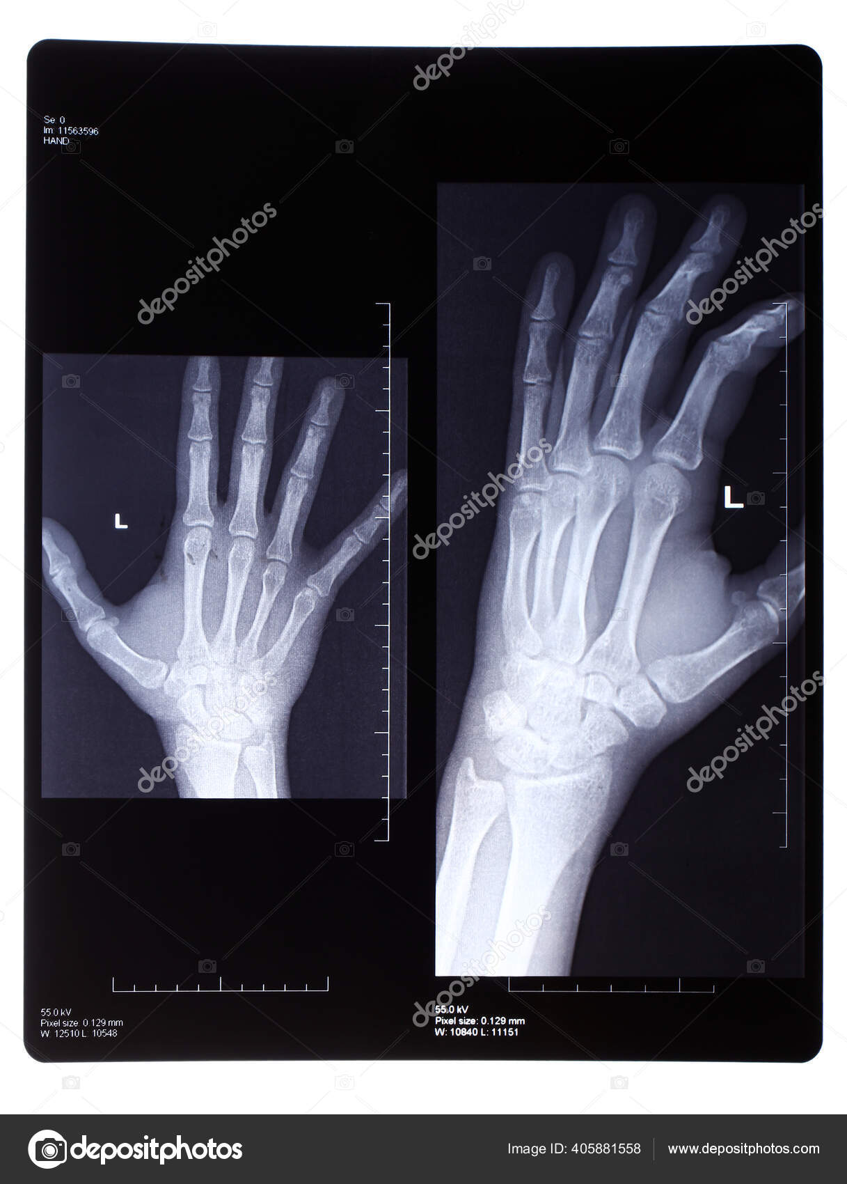 Xray Broken Hand