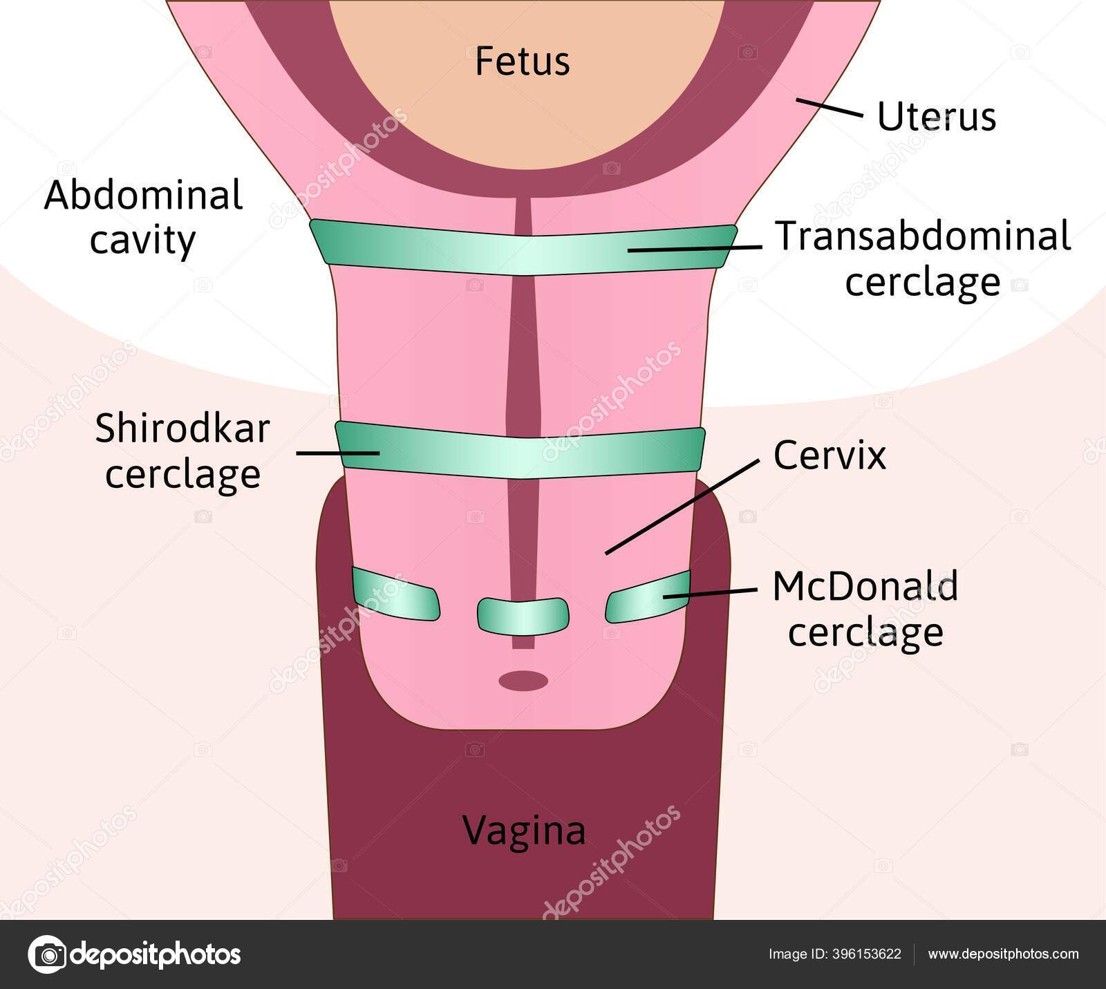 Que Es Un Cerclaje Cervical En El Embarazo En Mexico - Infoupdate.org