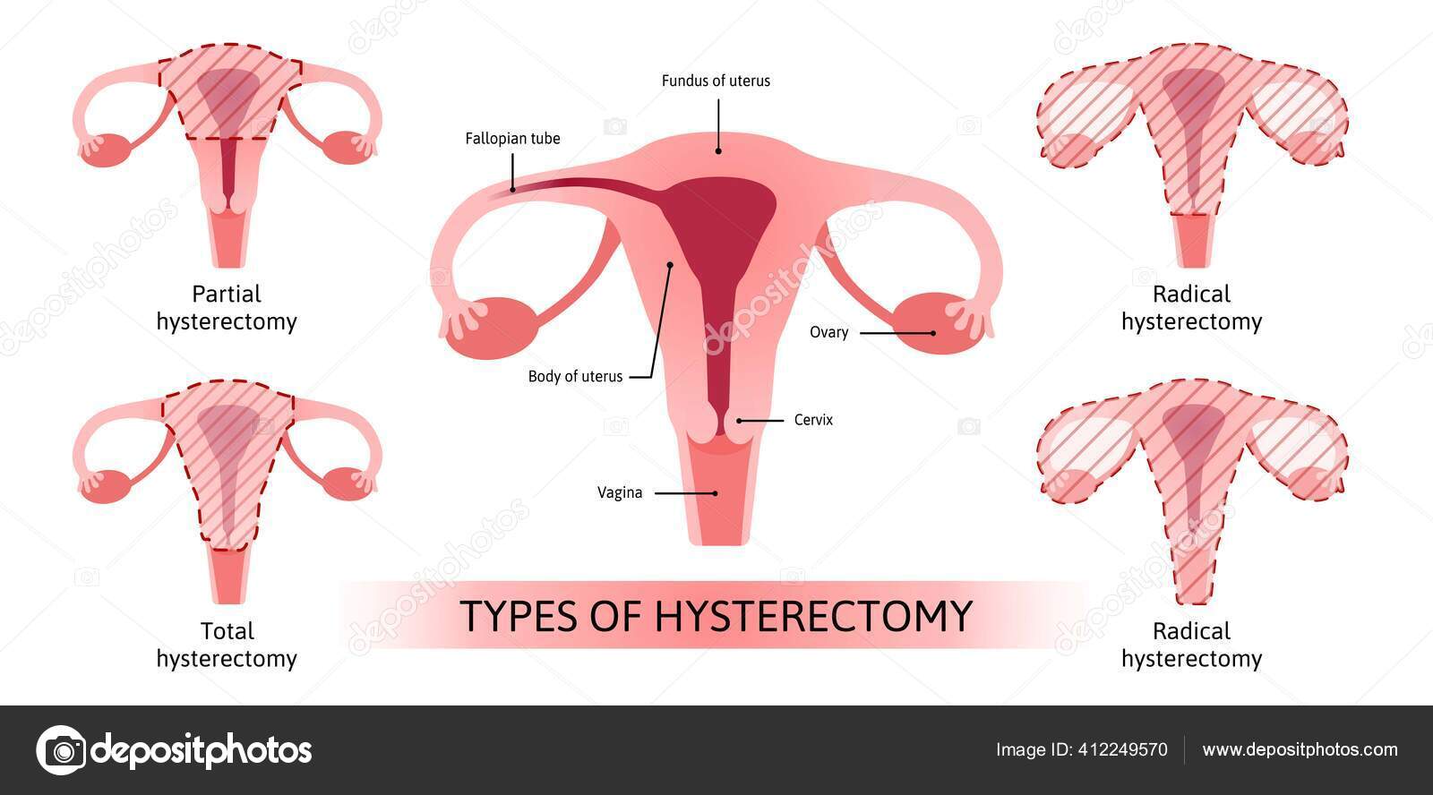 Hysterectomy Surgical Removal Uterus Medical Vector Illustration Shows Types Hysterectomy Stock ...