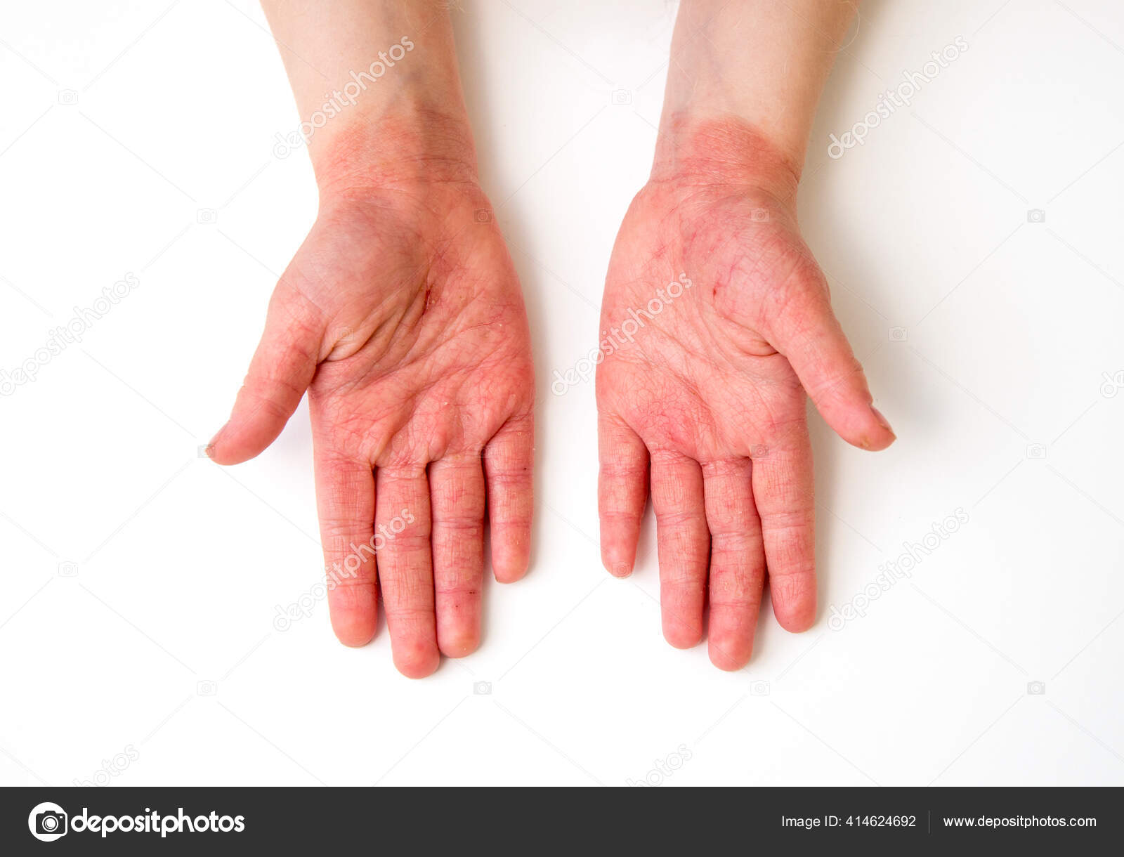 Year Old Child Red Swollen Cracked Atopic Dermatitis Hands Caused ...