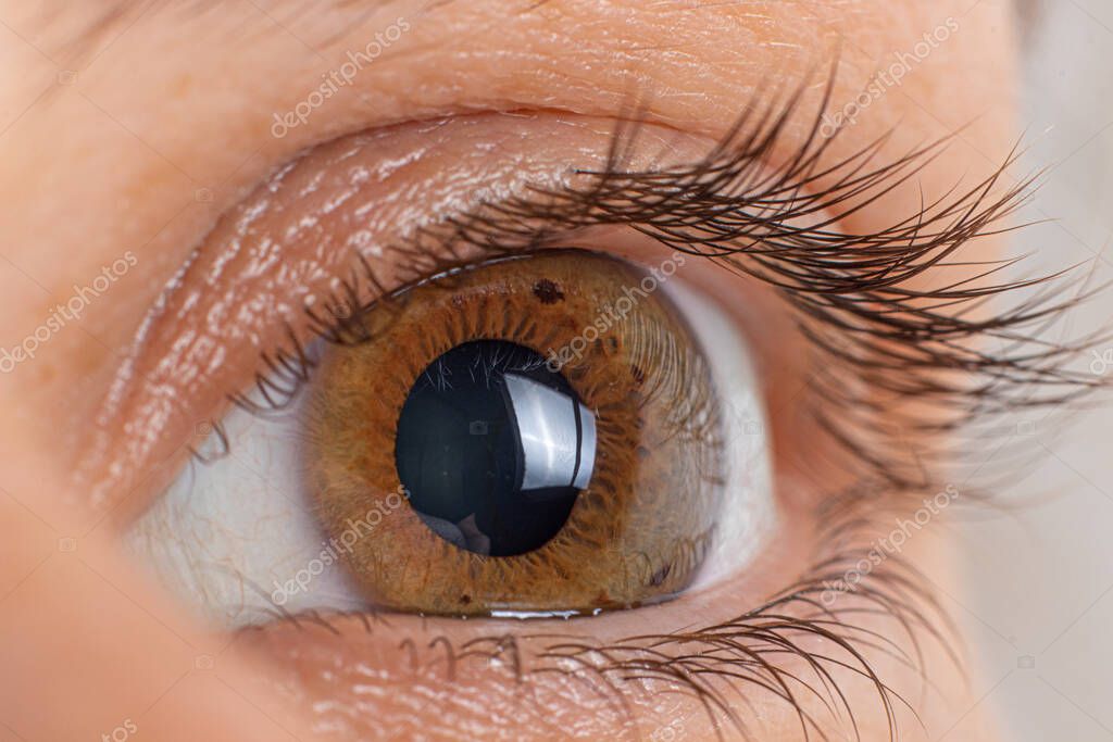 Foto de ojo macro. Queratocono 2 grado - enfermedad ocular ...