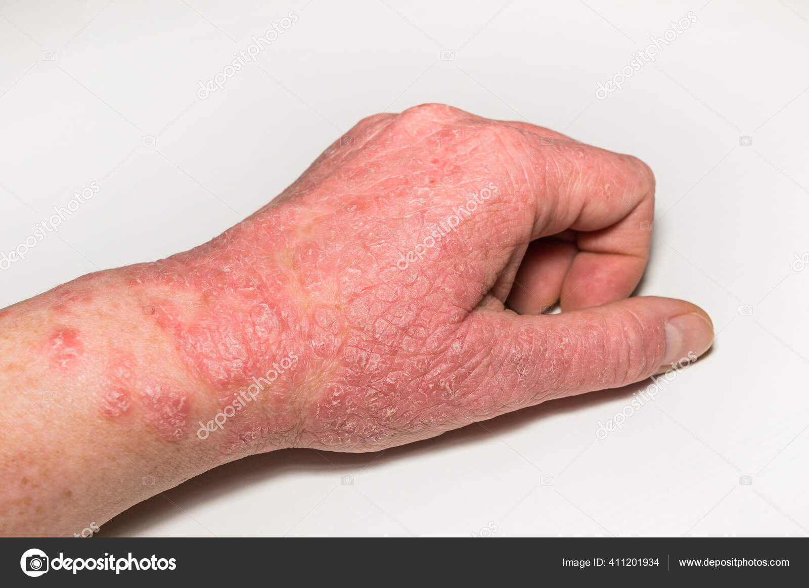 Atopic Dermatitis Hands