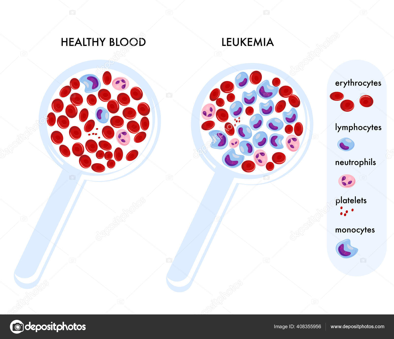 Magnifying Glass Normal Blood Leukemia Medical Science Education ...