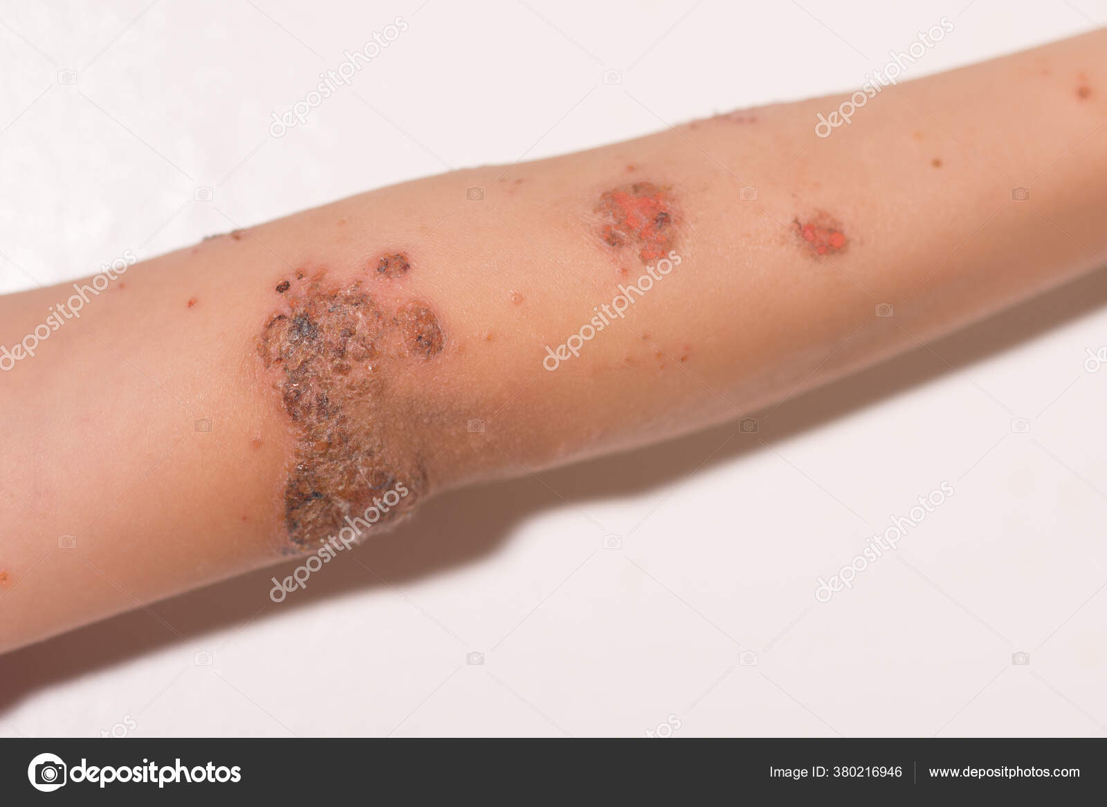 Mild Impetigo On Arm