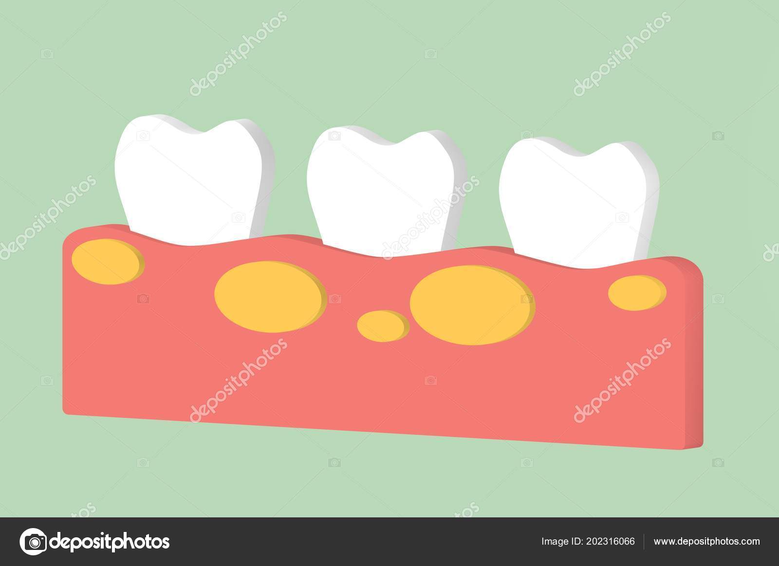 Unhealthy Teeth Because Gingivitis Abscess Gum Dental Cartoon Render ...
