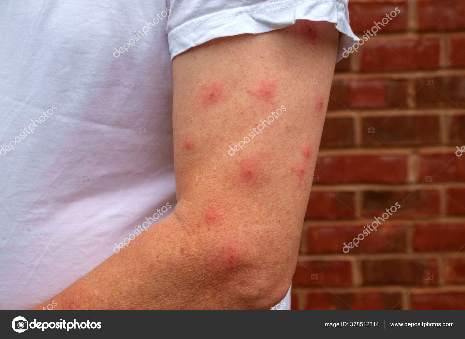 Mosquito Bites Allergy Treatment