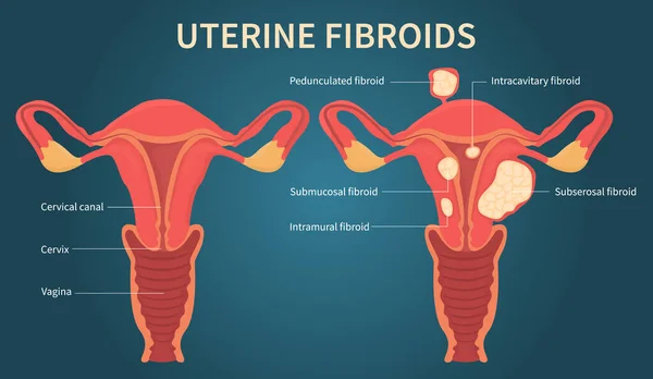 Esquema de fibromas uterinos sobre fondo azul oscuro 2024