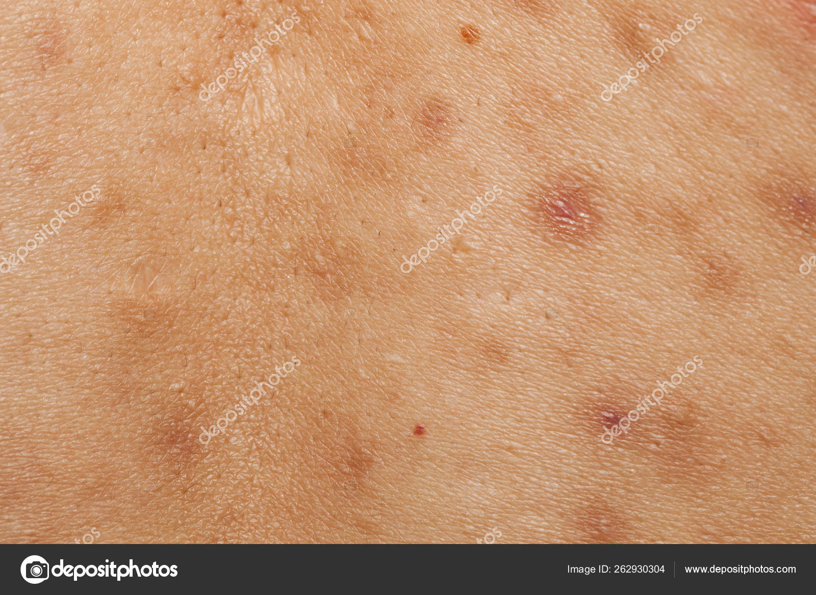 Boy with problematic skin and acne scars in the back Stock Photo by ...