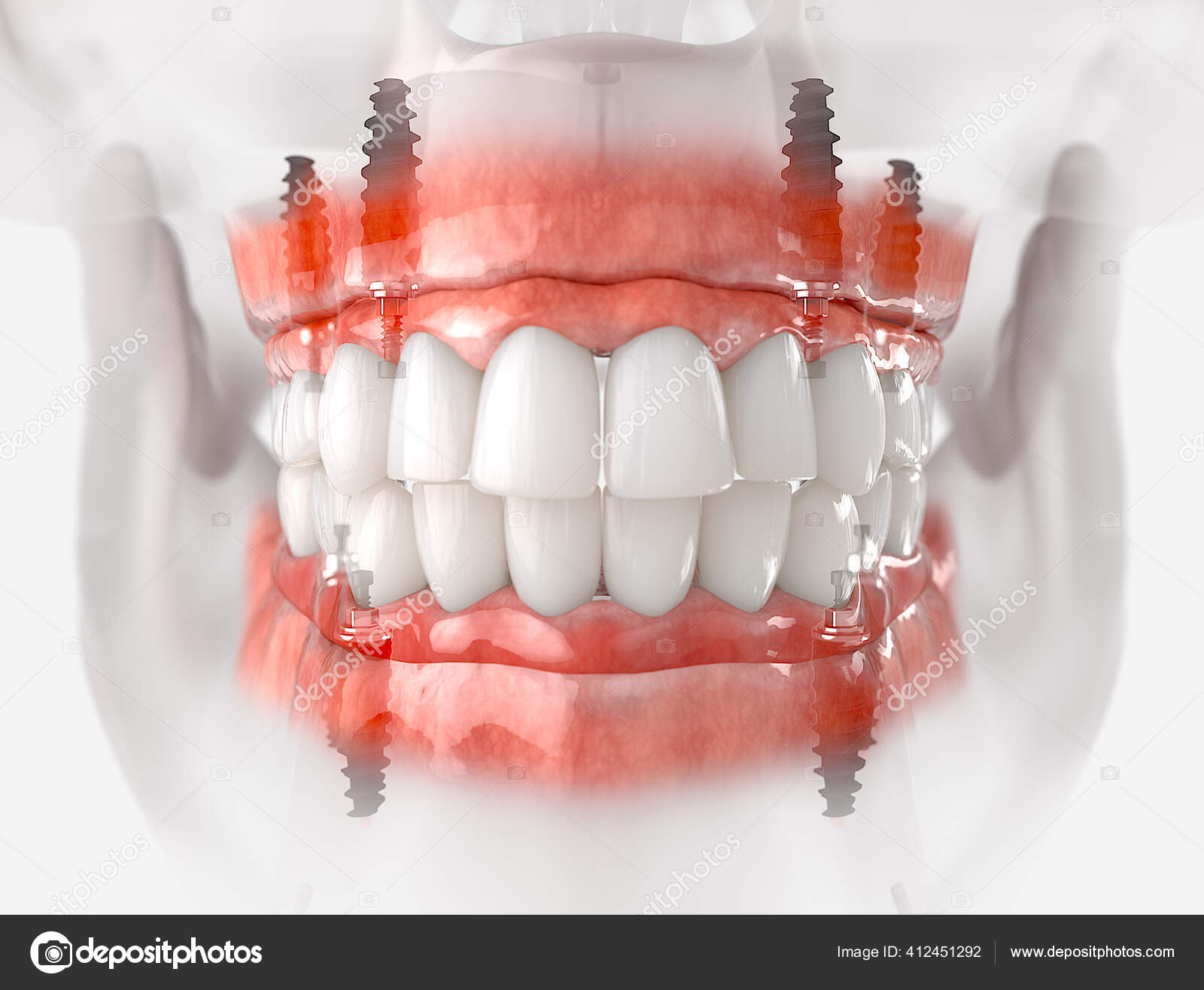 Mandibular Maxillary Prosthesis Illustration White Background Stock ...
