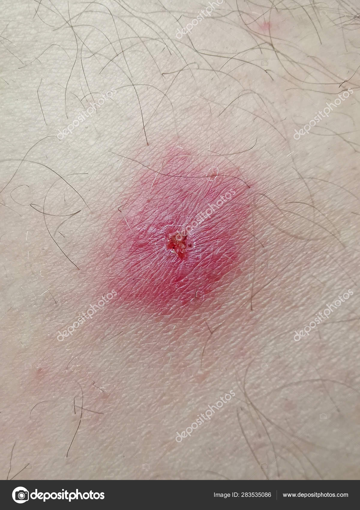 Gros plan d'une piqûre d'insecte image libre de droit par ...