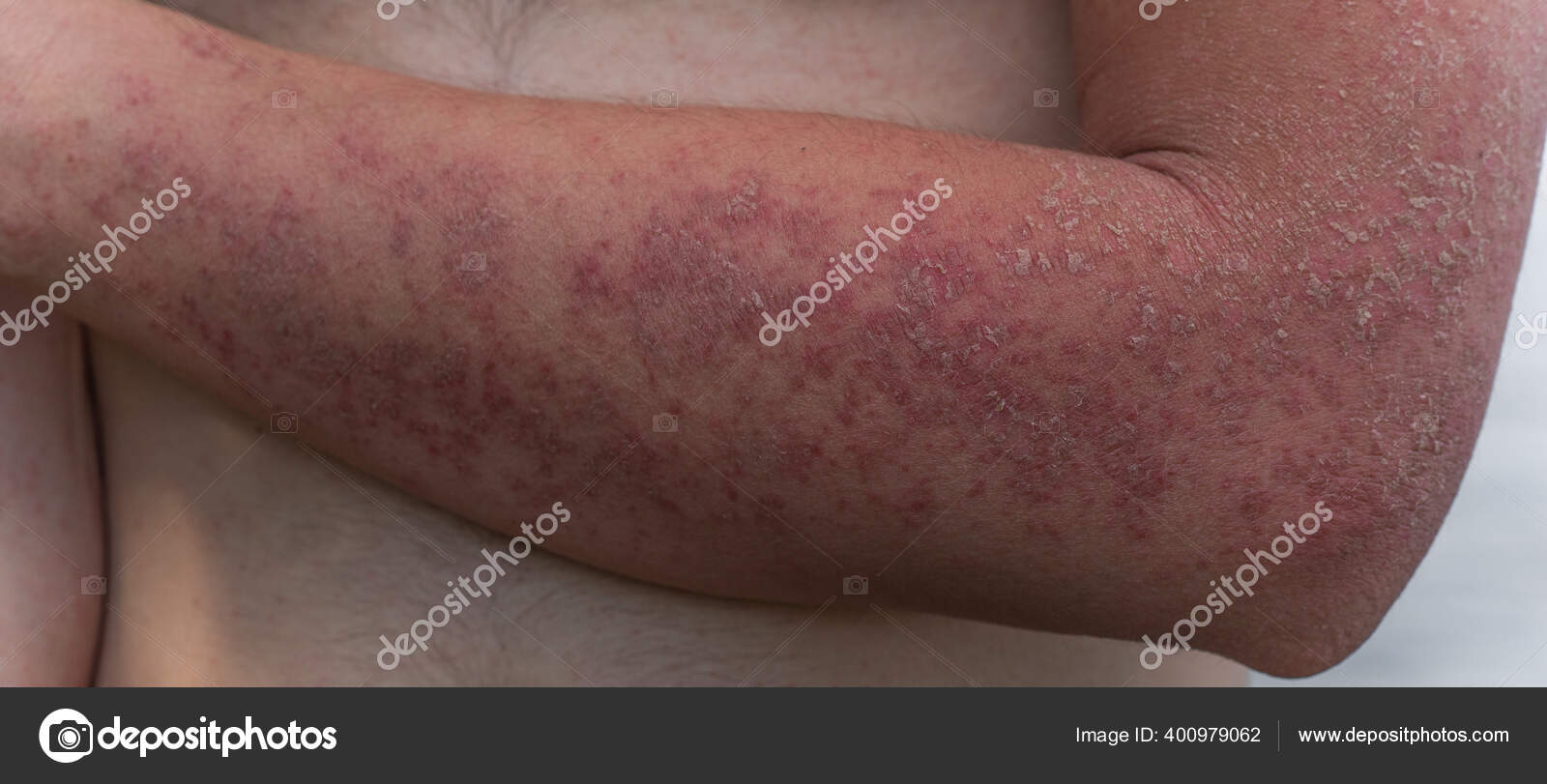 Eczema On Face And Arms at Gabriel Faulkner blog