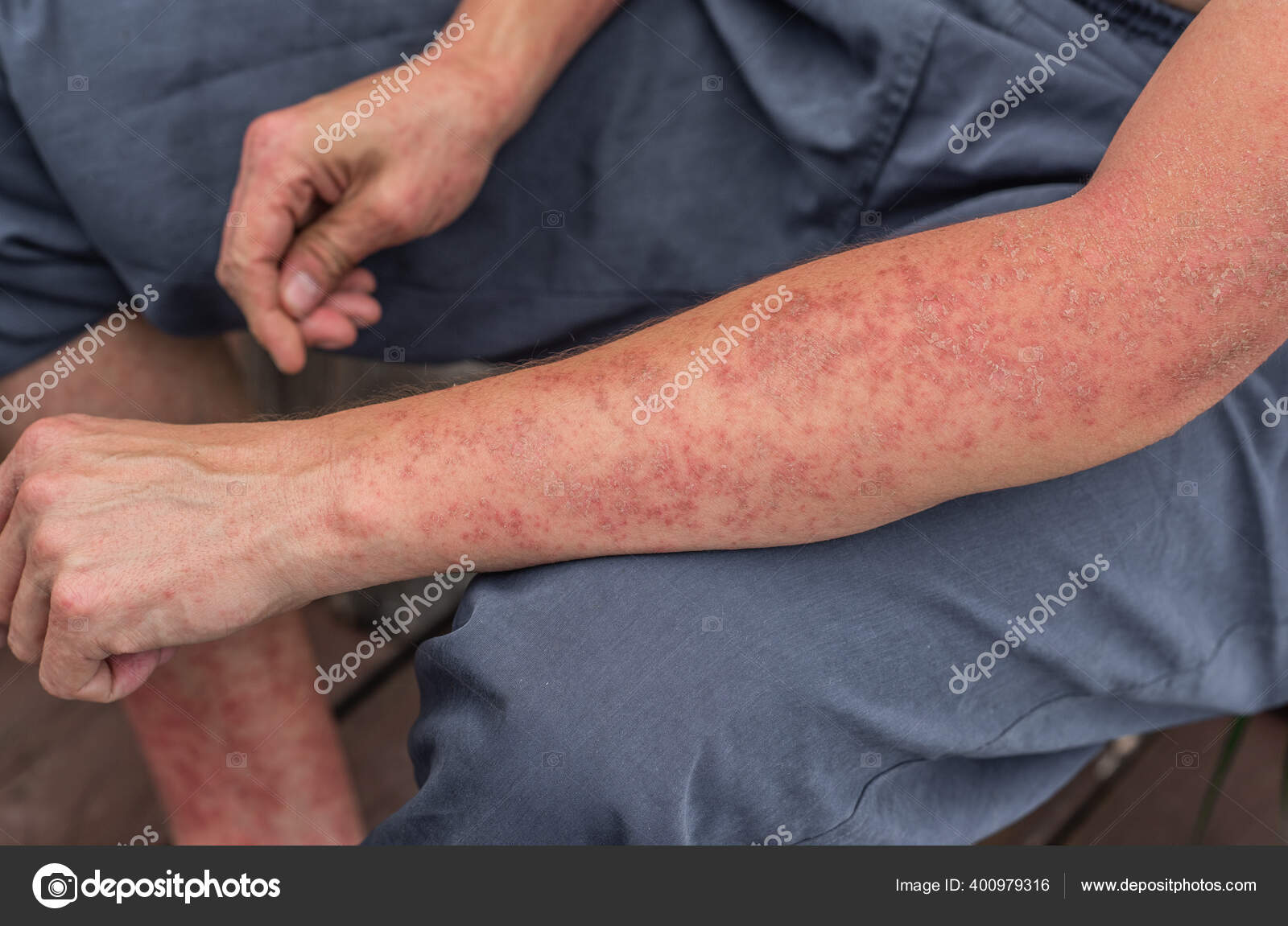 Dyshidrotic Autoimmune Eczema Patient Concept Health Care — Stock Photo ...
