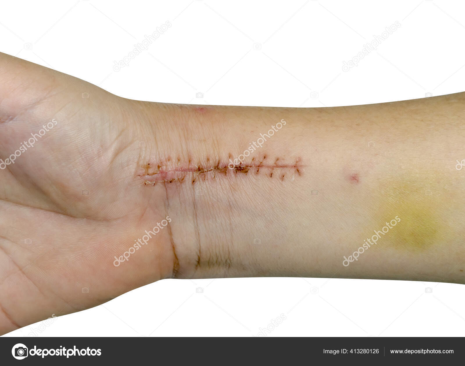 Puntadas Primer Plano Cirugía Brazo Roto Magullado Aislado Sobre Fondo ...