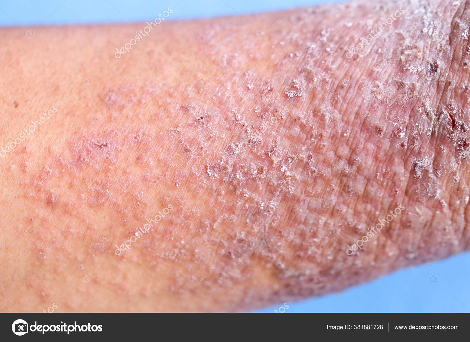 Dermatitis Atópica También Conocida Como Eccema Atópico Tipo ...