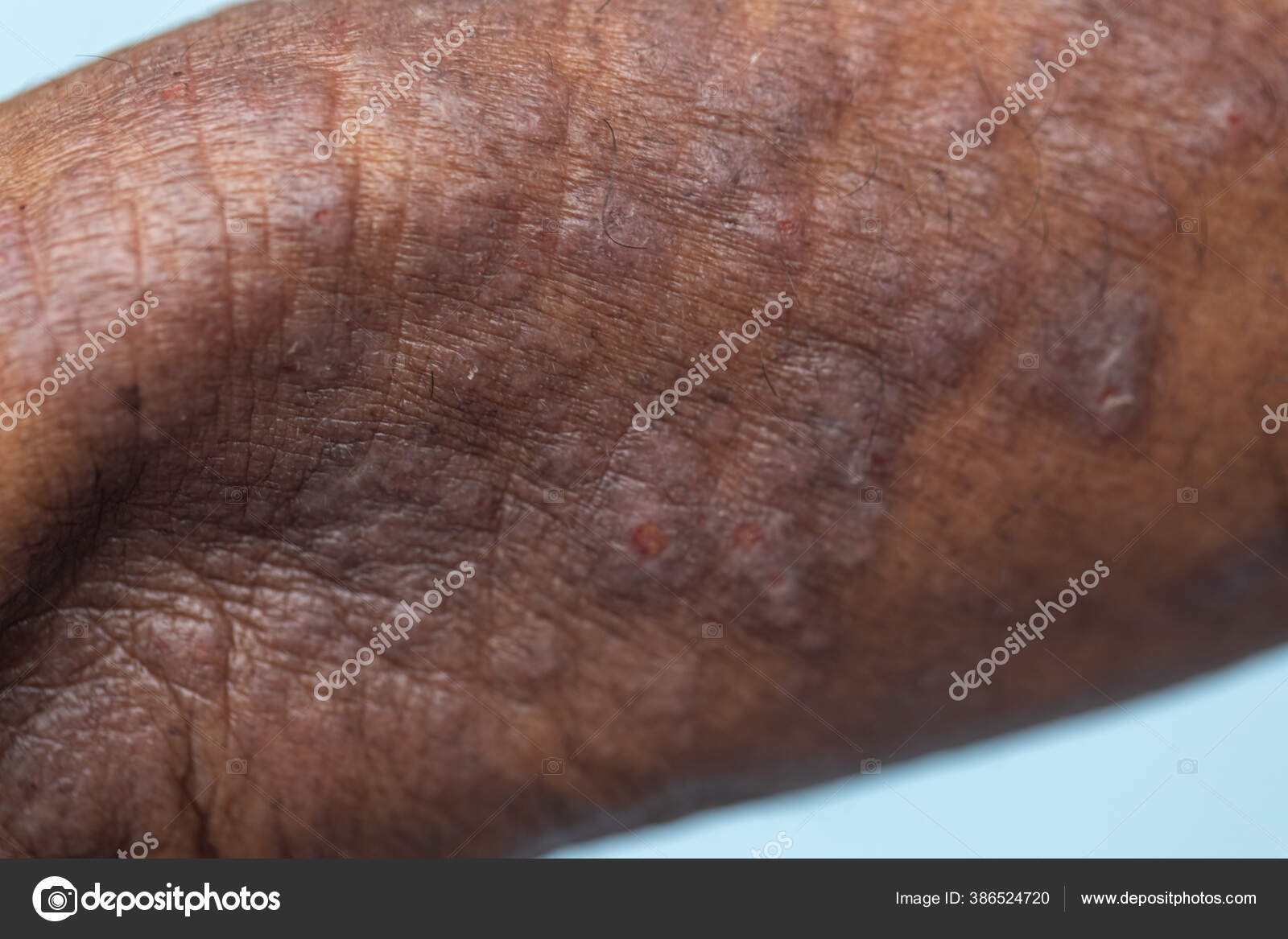 Físico Dermatitis Atópica También Conocida Como Eccema Atópico Tipo ...