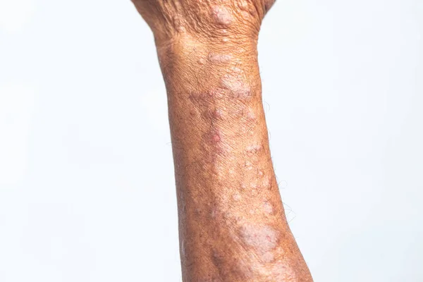 Physical Atopic Dermatitis Also Known Atopic Eczema Type Inflammation ...