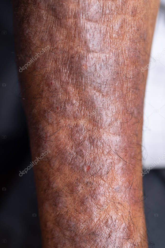 Un físico de la dermatitis atópica (DA), también conocida como eccema ...