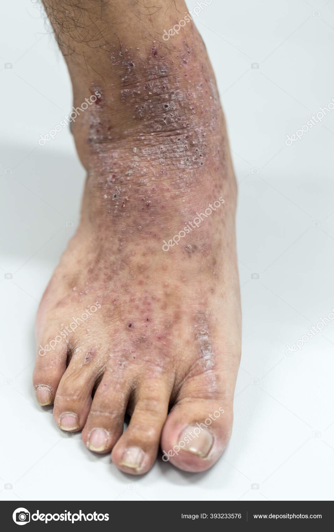 Físico Dermatitis Atópica También Conocida Como Eccema Atópico Tipo ...