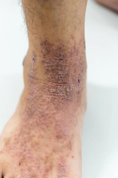 Physical Atopic Dermatitis Also Known Atopic Eczema Type Inflammation ...