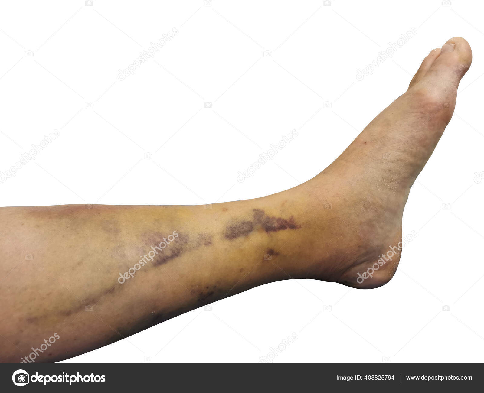 Contusion Leg Impact Injury Isolated White Background Stock Photo by ...