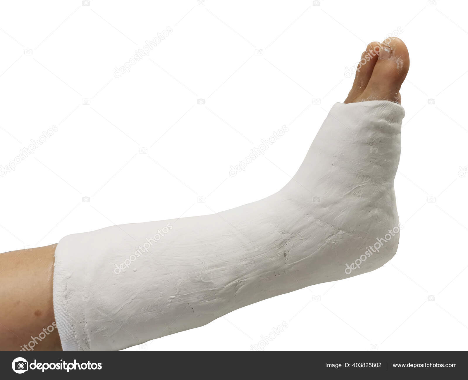 Plaster Cast