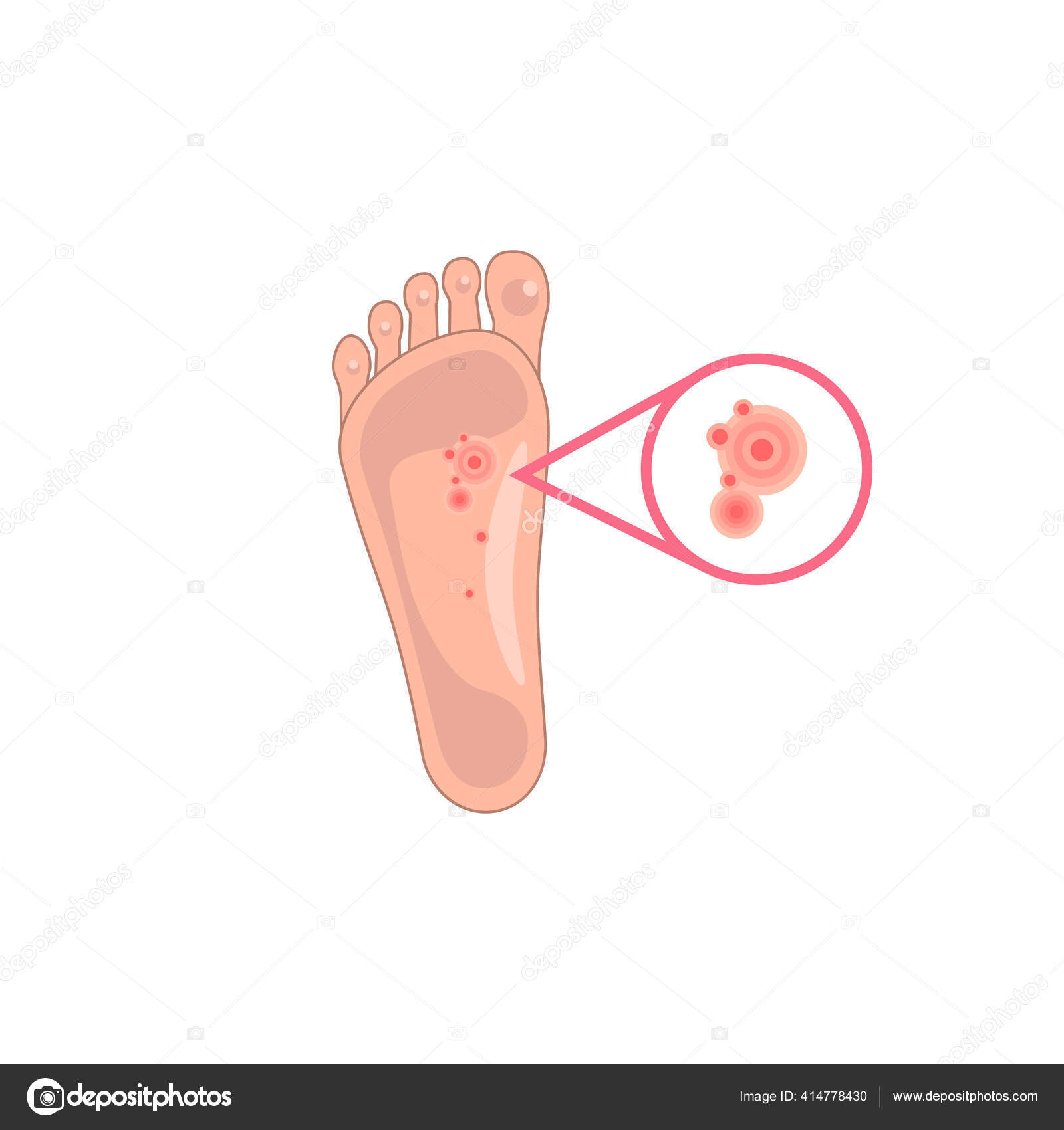Eczema On Bottom Of Foot