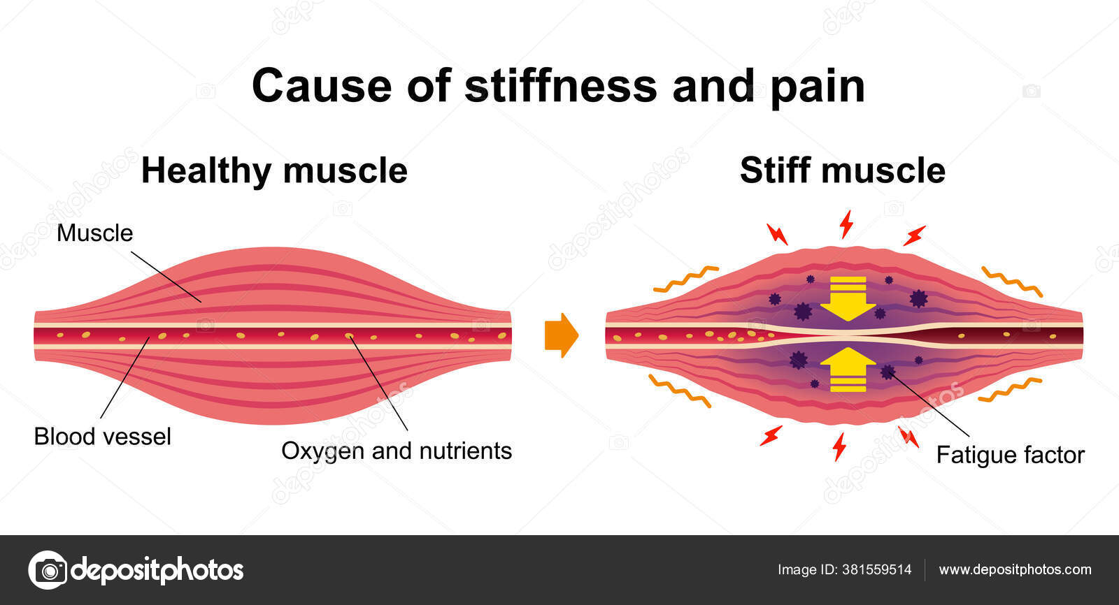 Muscle Rigidity