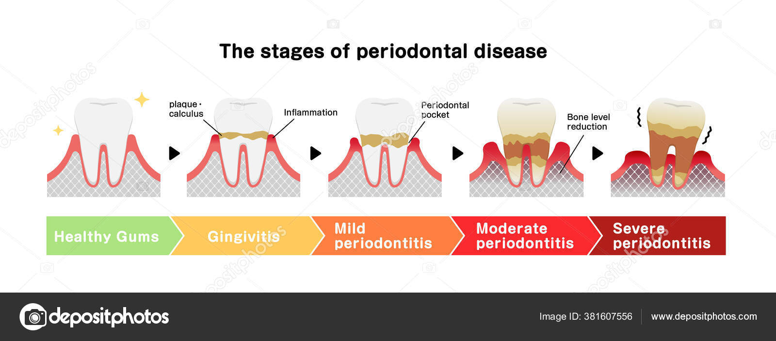 Stages Periodontitis Disease Vector Illustration Stock Vector by ©barks ... Stages Periodontitis Disease Vector Illustration Stock Vector by ©barks ...