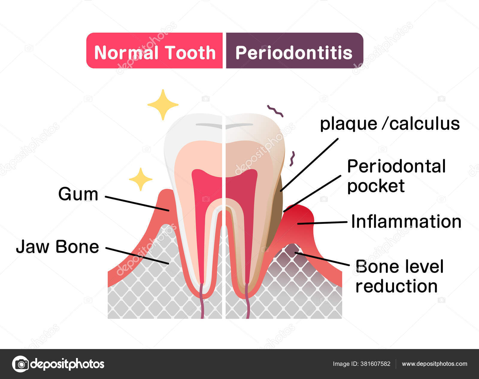Comparación Dientes Normales Enfermedad Periodontal Ilustración ...