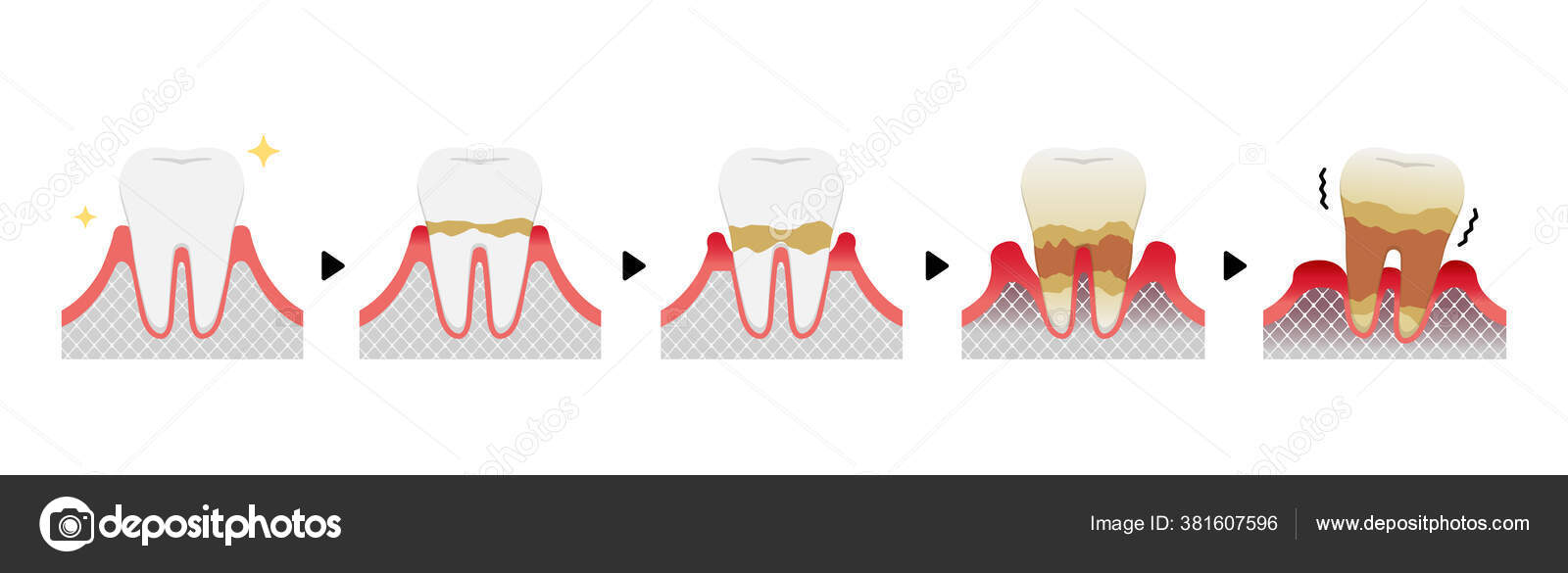 Stages Periodontitis Disease Vector Illustration — Stock Vector © barks ...