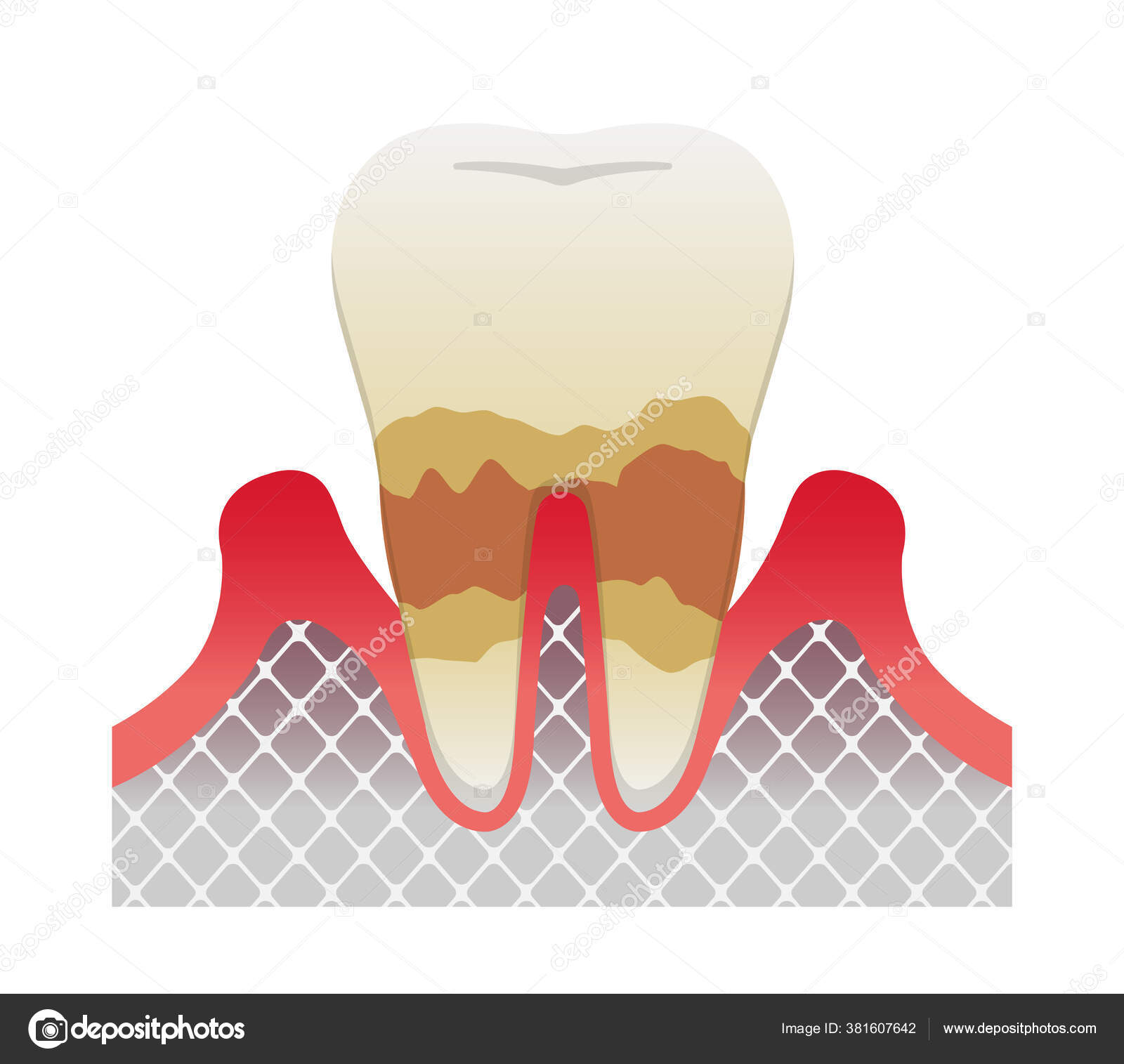 Las Etapas Enfermedad Periodontitis Periodontitis Moderada — Vector de ...