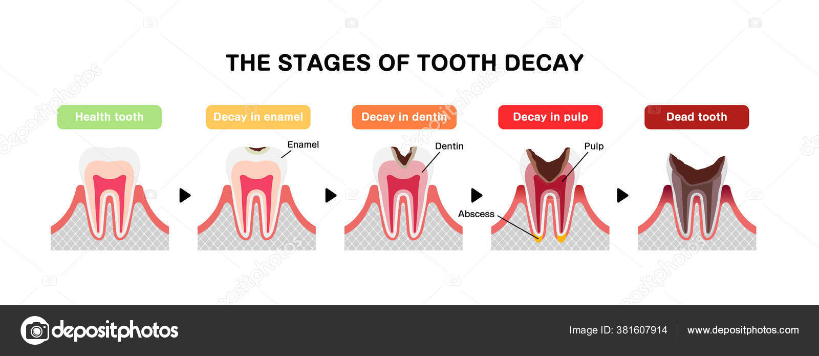 Stages Tooth Decay Flat Vector Illustration Stock Vector Image by ...