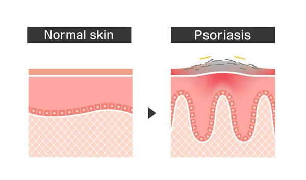 Cross Section Psoriasis Normal Skin Flat Vector Illustration Stock ...