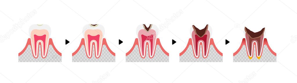 Las etapas de la caries dental / ilustración de vectores planos (sin ...