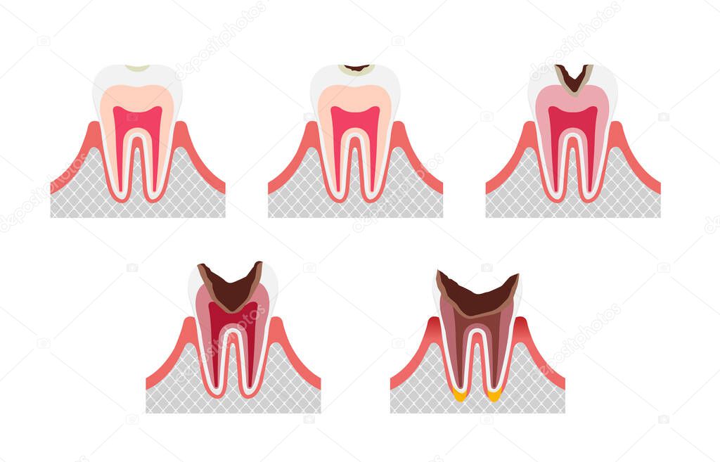 Las etapas de caries dental / conjunto de ilustración de vectores ...