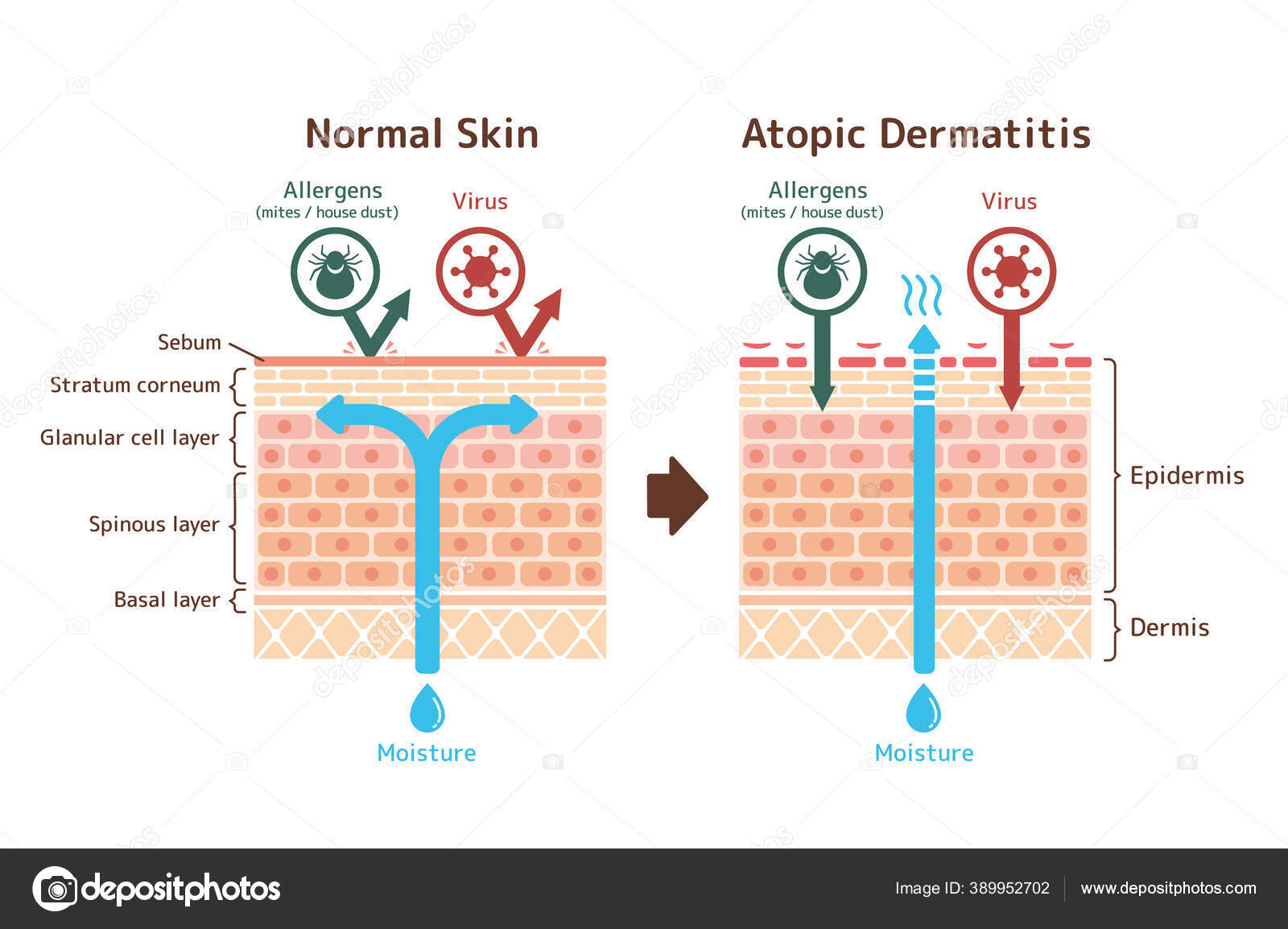 Sectional View Atopic Dermatitis Normal Skin Comparative Vector ...