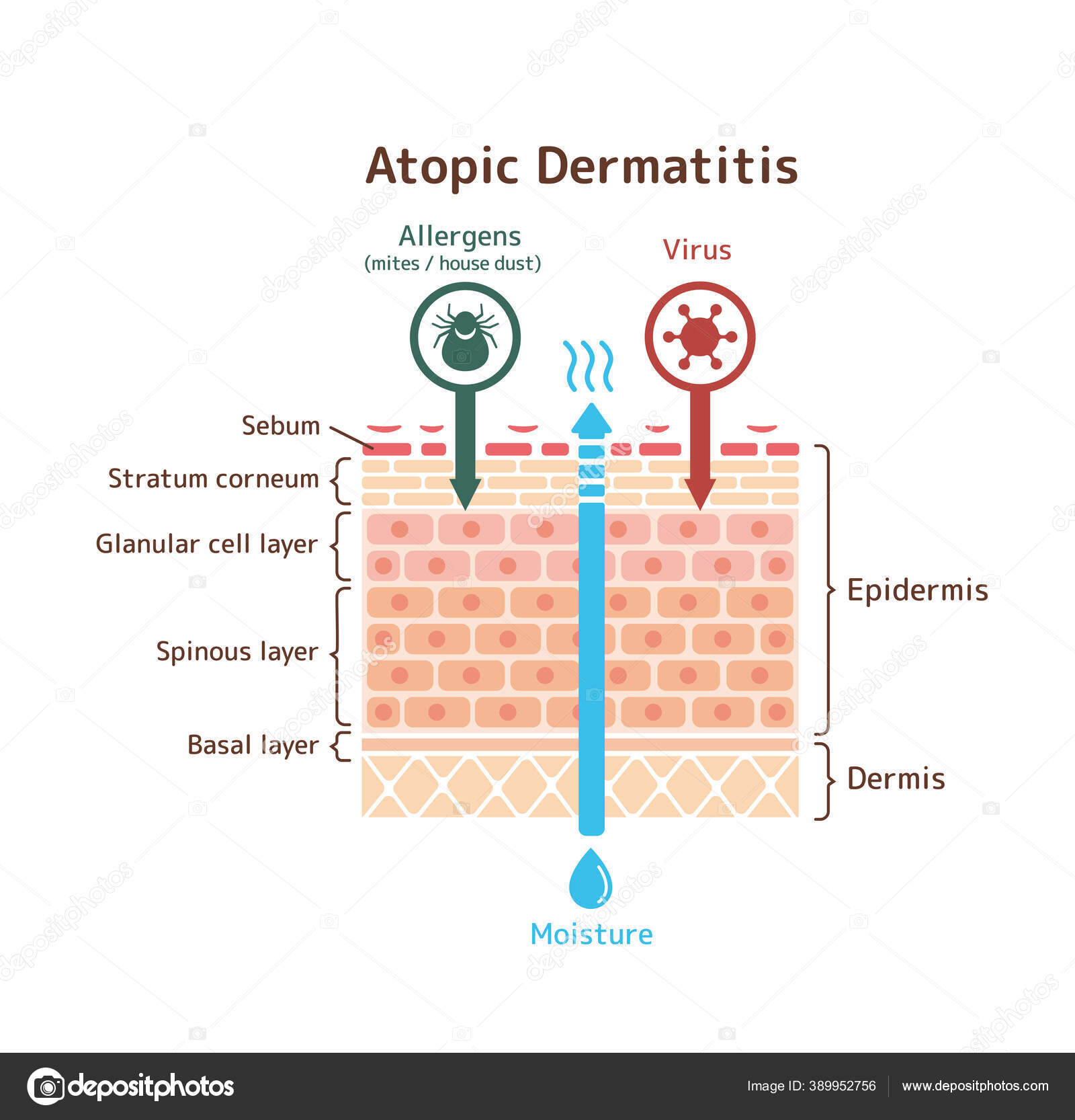 Sectional View Atopic Dermatitis Vector Illustration Stock Vector by ...