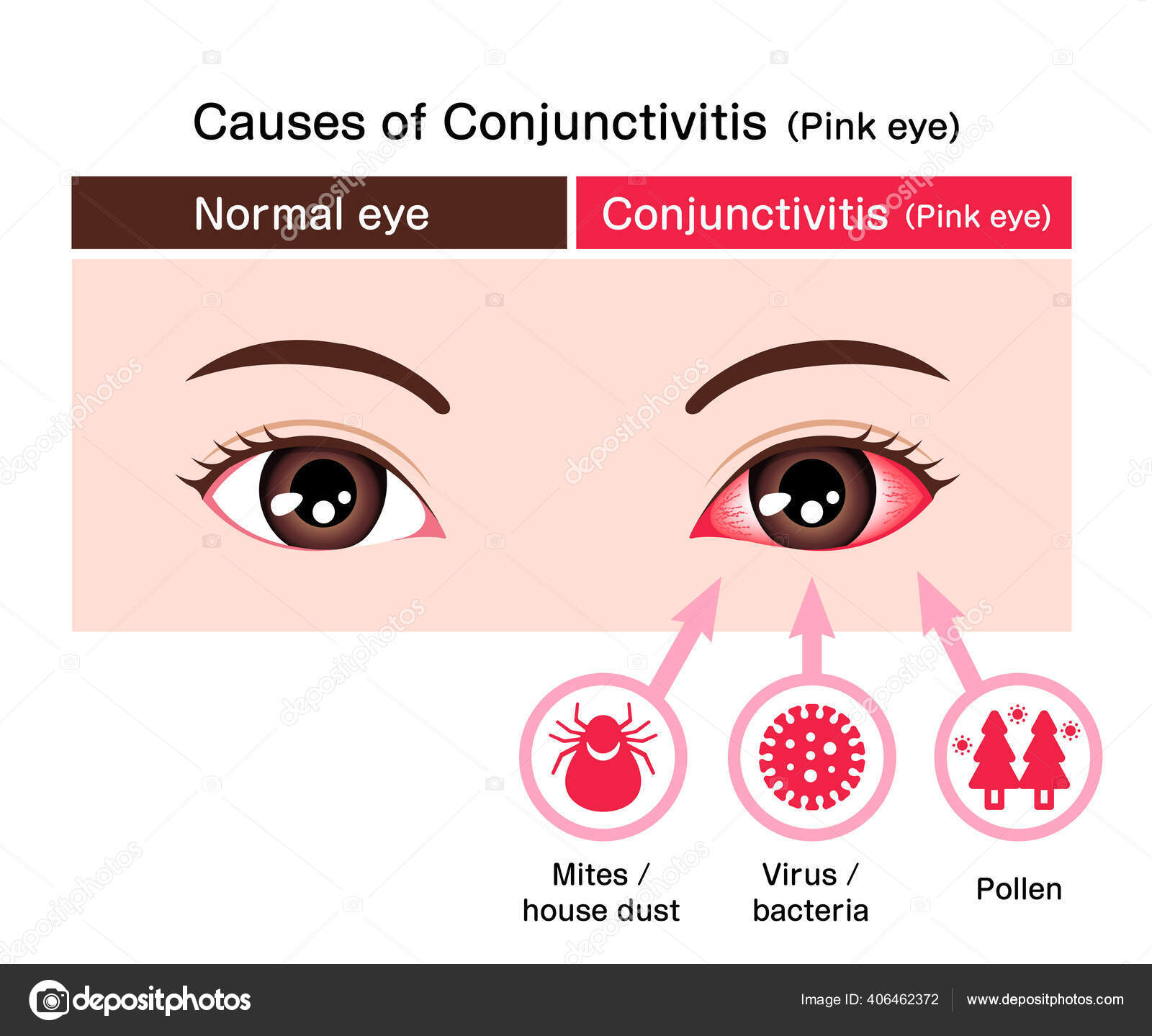 Causes Conjonctivite Oeil Rose Illustration Vectorielle Vecteur par ...
