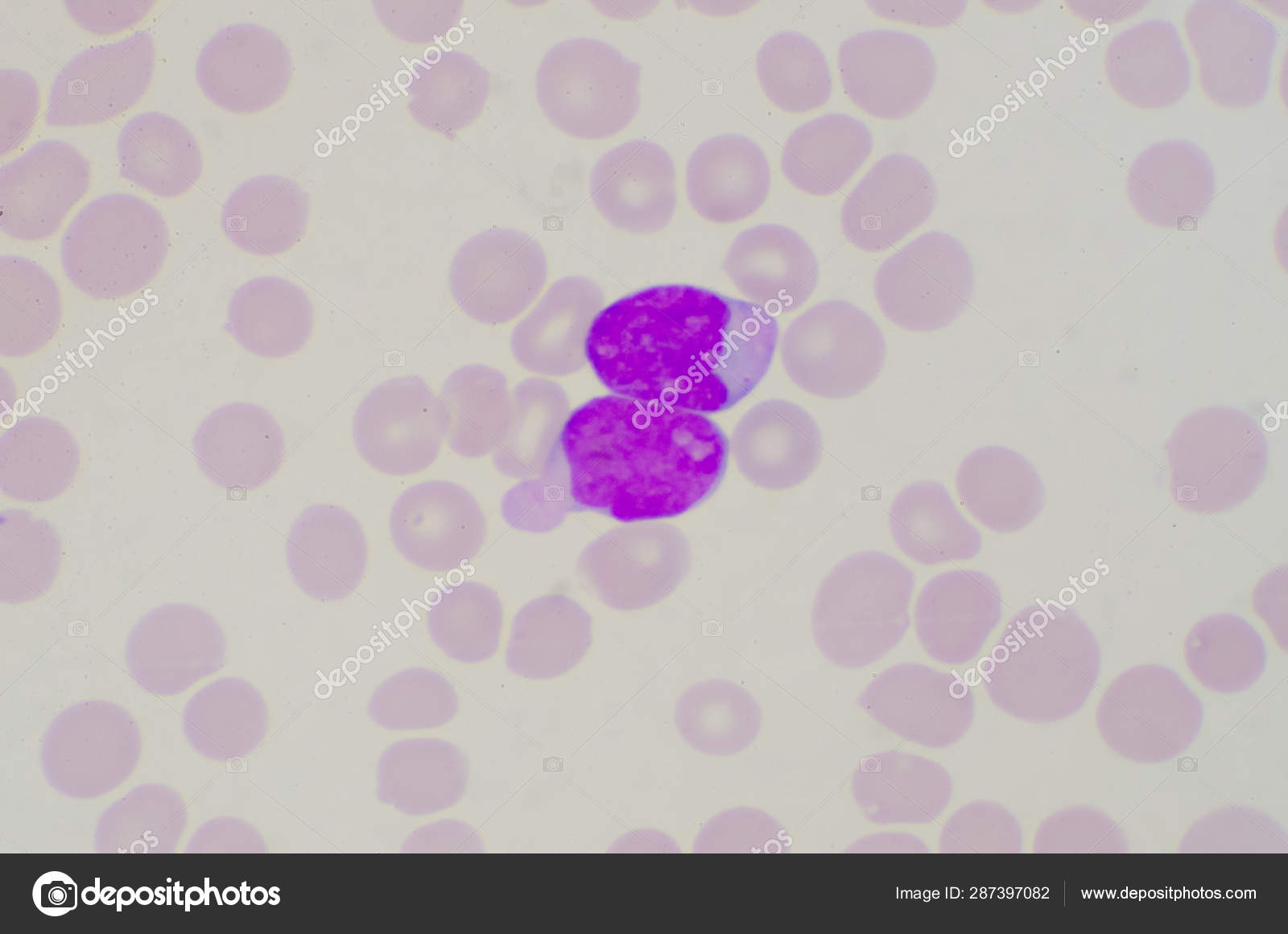 Burst Red Blood Cells Smear