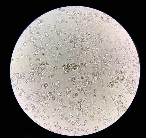 Pseudohyphae In Urine