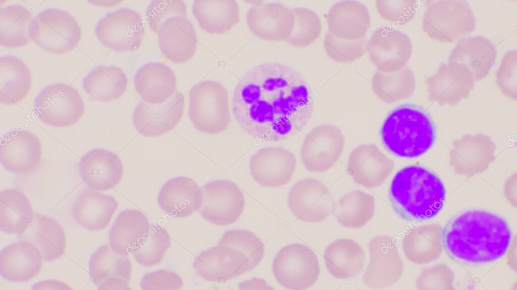 Neutrofilo hipersegmentado más de 5 lóbulos con linfocitos sobre el ...