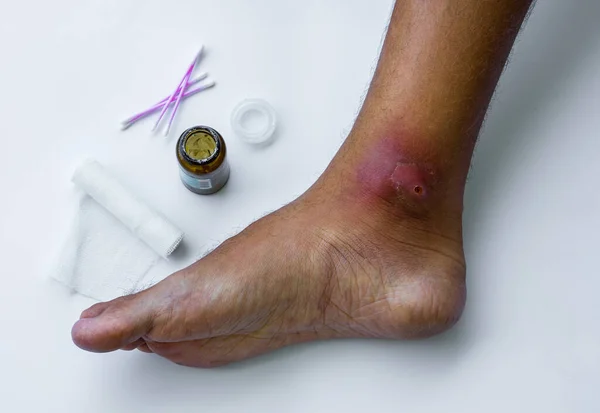 Abcessos Stock Photos, Royalty Free Abcessos Images | Depositphotos