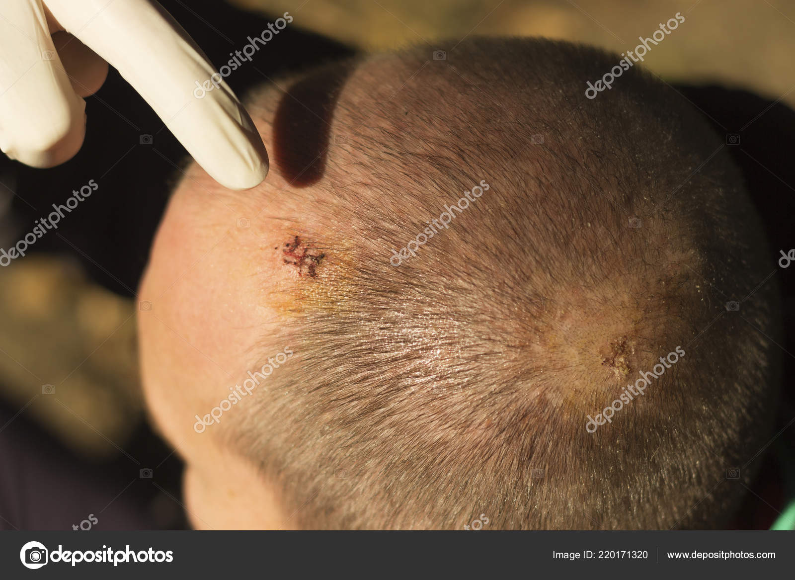 Stitches In Head