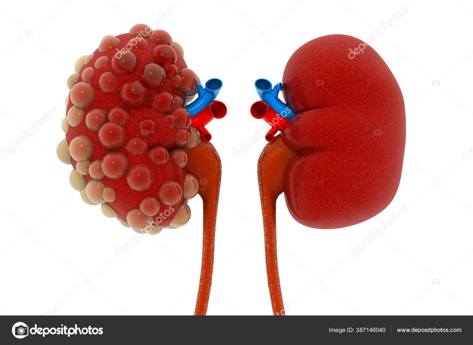 Kidney Disease White Background Illustration Stock Photo by ...