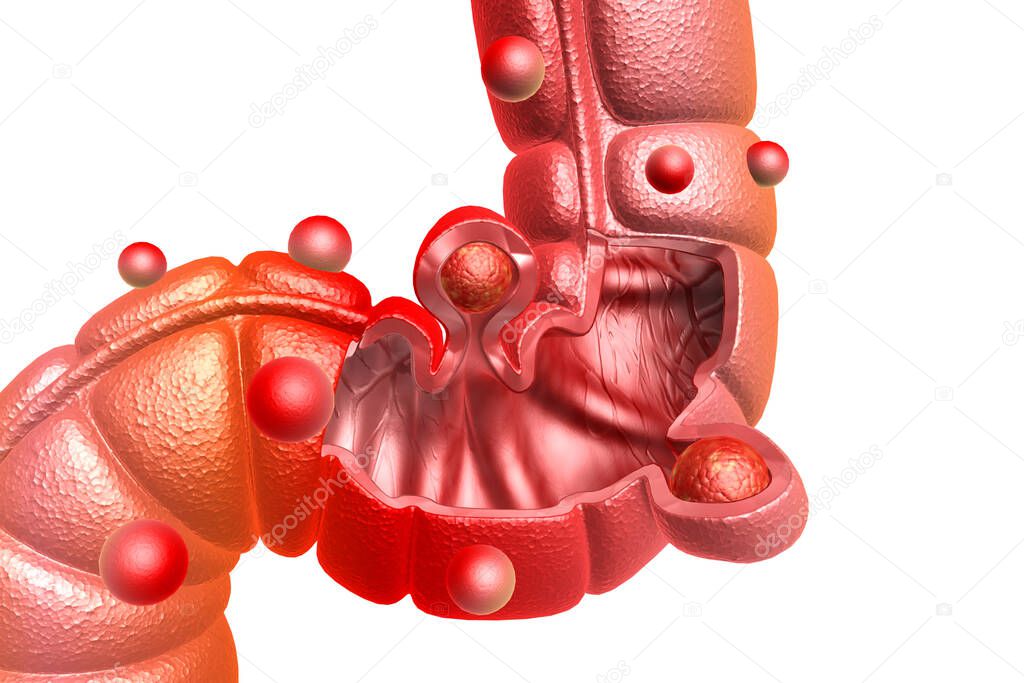 Enfermedades de colon sobre fondo blanco 2024