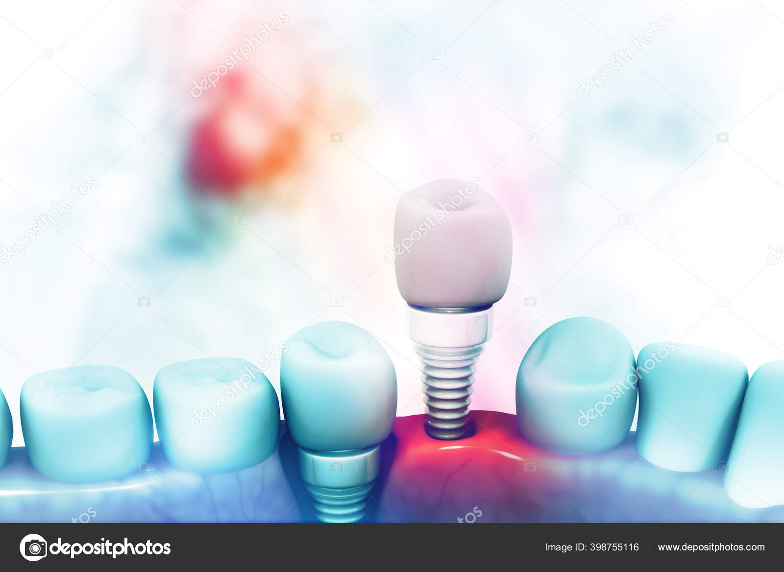 Dental Implant Structure Science Background Illustration Stock Photo by ...