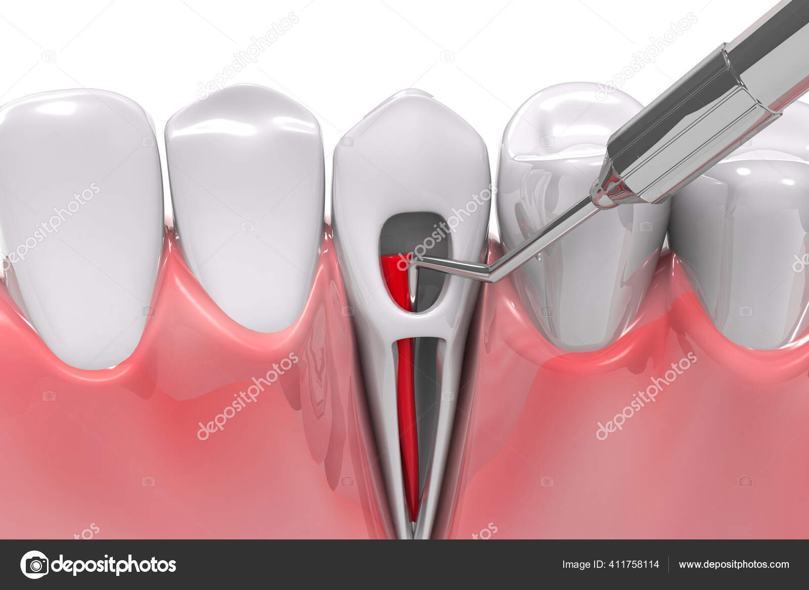 Processo Tratamento Canal Radicular Renderização — Foto © crytallight ...