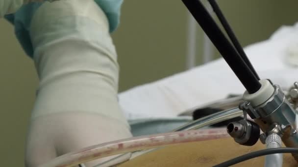 Abdominal laparoscopy in operating room close-up. — Stock Video ...