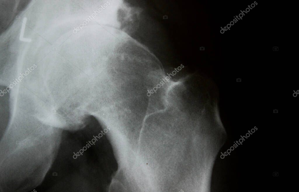 Imagen de rayos X del hueso de la cadera con degeneración de la ...